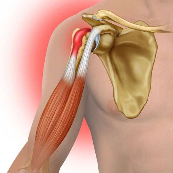 Biceps Tendon Procedures | Orthopedic Shoulder Surgeon | Vail, Aspen, Denver, Colorado